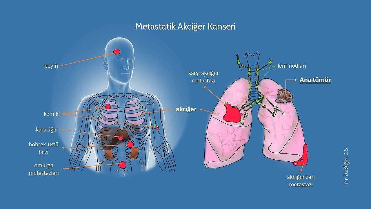 Kanser Nedir? Kanser Nasıl Oluşur? Tedavi Yöntemleri Nedir? - Ağrı ...